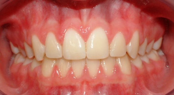 Inovadent: INDICAÇÕES PARA TRATAMENTO ORTODÔNTICO