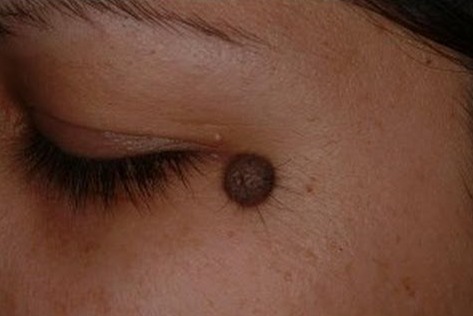 Photos of Moles on Face and Neck ~ How To Remove Moles, Warts, Skin ...