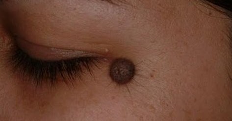 Photos of Moles on Face and Neck ~ How To Remove Moles, Warts, Skin ...