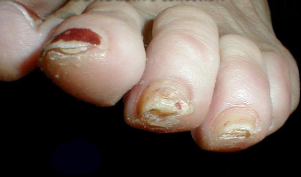 What Is Aspergillosis? - Teroes