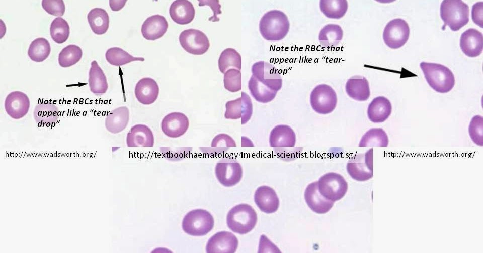Haematology in a NutShell: Tear-Drop RBCs ( Dacrocytes)