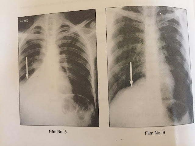 XRAY COLLAPSE OF THE LUNG
