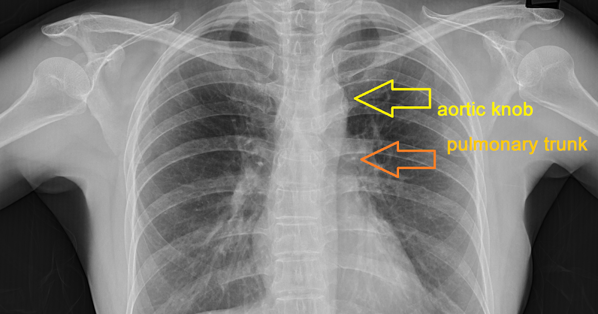 BRH-MICCAL-Learning: Enlarged pulmonary trunk