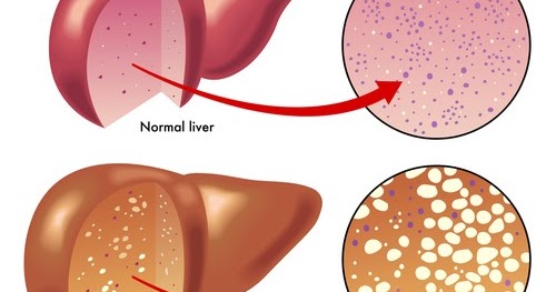 Ayurvedic Treatment of Hepatic Steatosis - Dr. Vikram's Blog ...