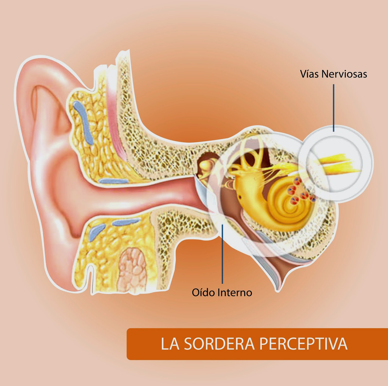 Audiomax: LA SORDERA PERCEPTIVA. AUDÍFONOS MEDICADOS