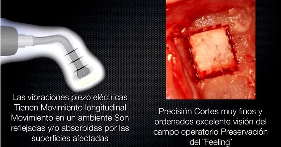 PIEZOTOME: Usos y Ventajas - Dr. Juan G. Martínez - Odonto-Tv
