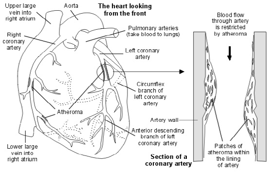 Keperawatan dan Kesehatan: Angiografi Koroner (Coronary Angiography)
