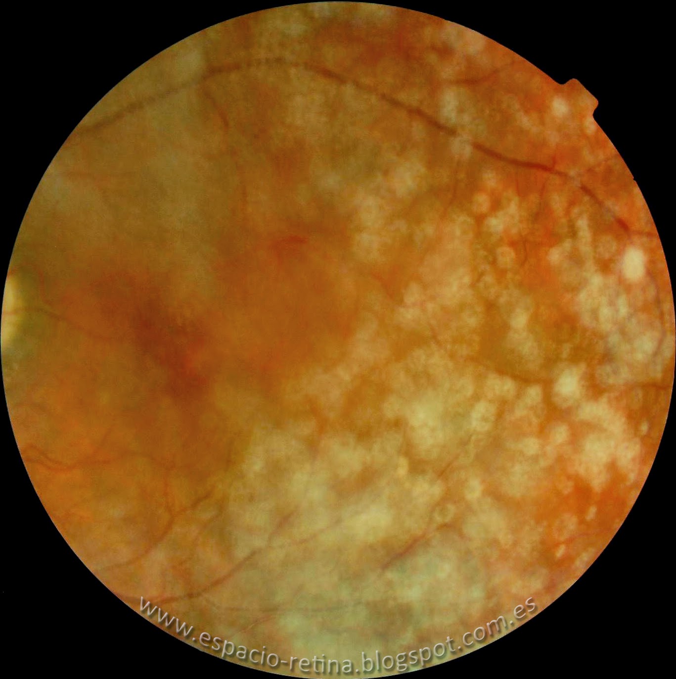 ESPACIO RETINA: Hialosis asteroide (enf. de Benson).