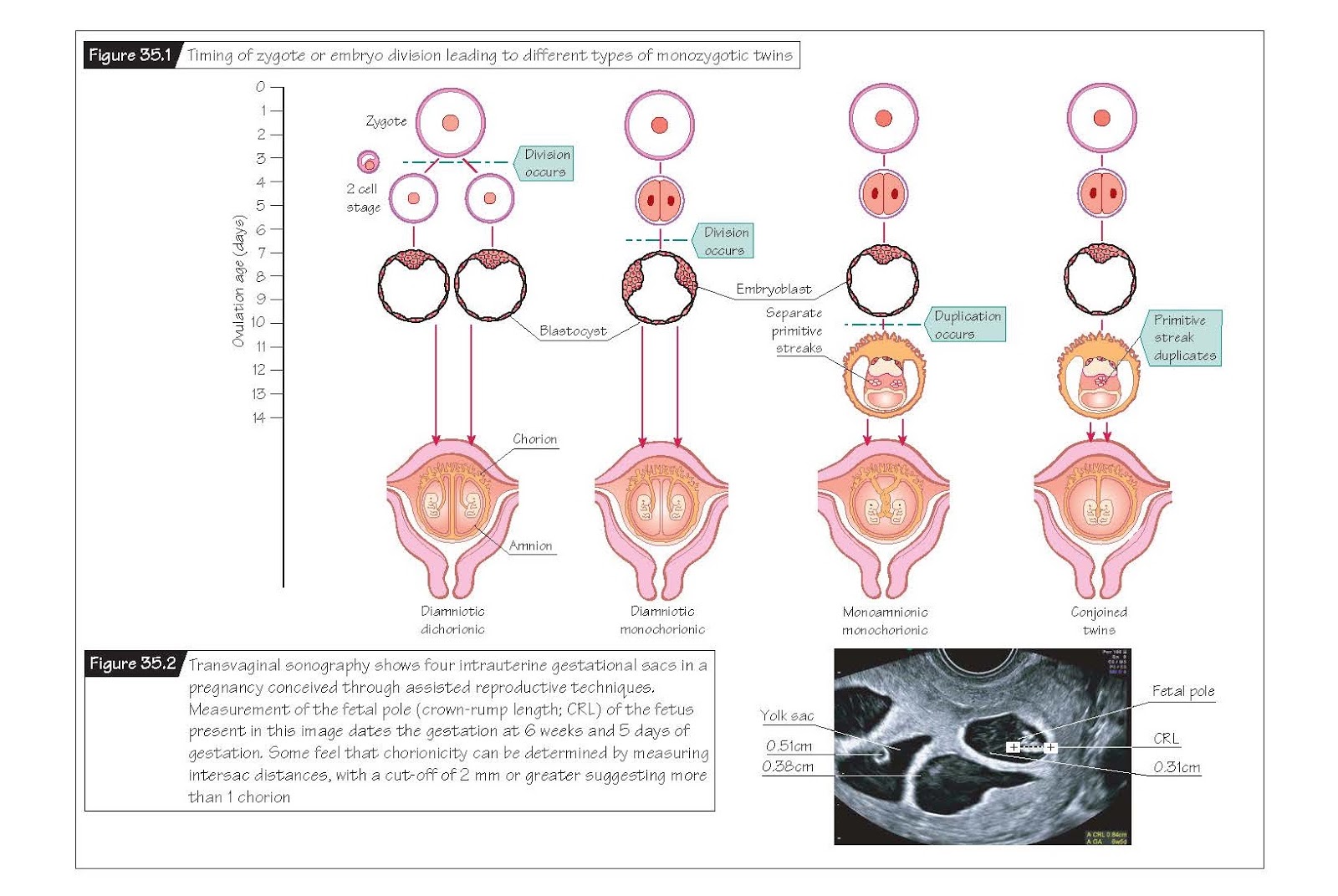 Multifetal Pregnancy - pediagenosis