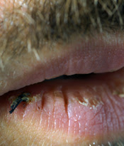 Dry Cracked Bloody Lips - pleaseapplication