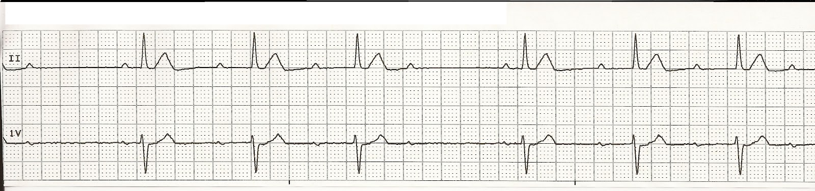 EKG Rhythm Strip Quiz 52: Heart Blocks