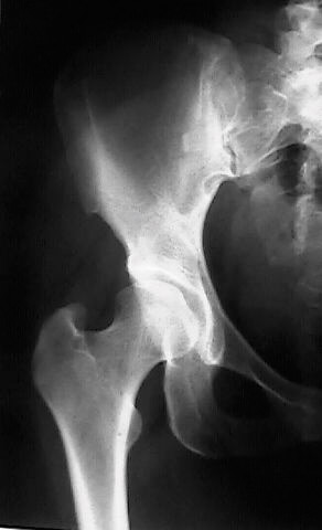 Prótesis Total de Cadera | Revista Médica Hoy