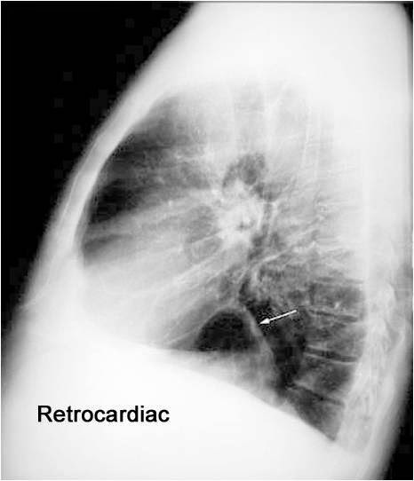RADIOLOGY IMAGE SPOTTERS: Hiatal hernia- retrocardiac air fluid level