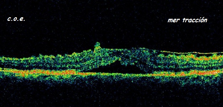 DEGENERACION MACULAR : OCT RETINA IX