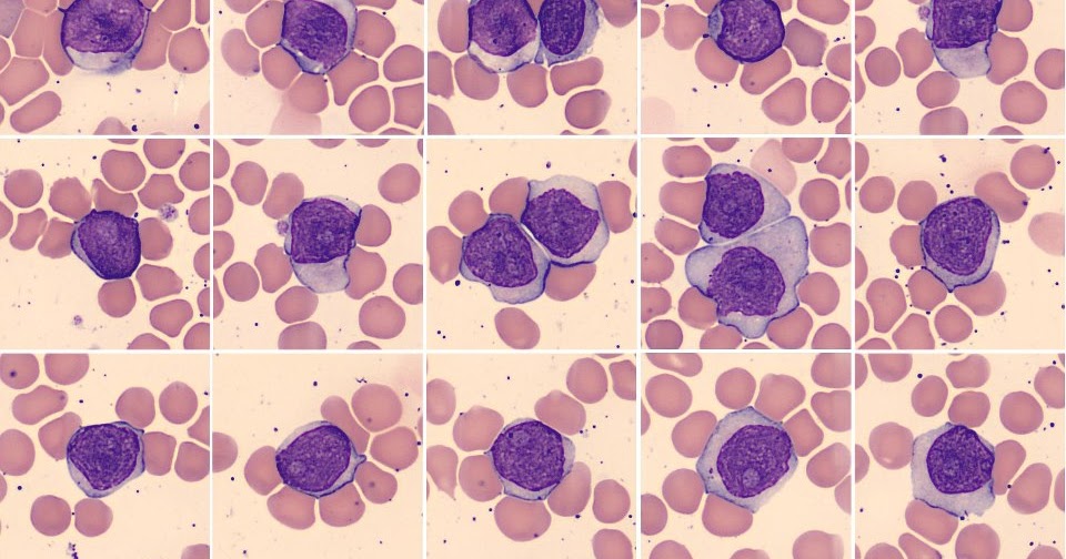 VETERINARY HEMATOLOGY DEXTERVET: Prolymphocytic Leukemia