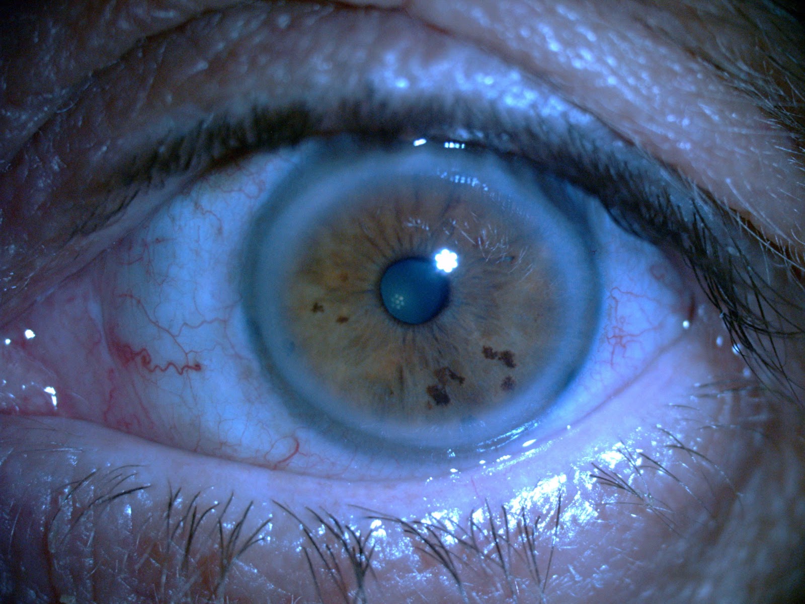 Vernon's Vision: CORNEAL ARCUS