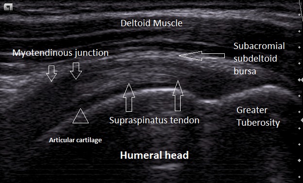 Theory Converted: Shoulder and collar bone pain - Rotator cuff tear ...
