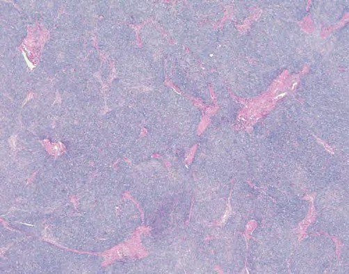 [Pathology] Atlas of Lymphocyte-Rich Spindle-Cell Thymoma (WHO Type AB ...