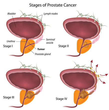 What Is Prostate Cancer? - Healthy Cancer
