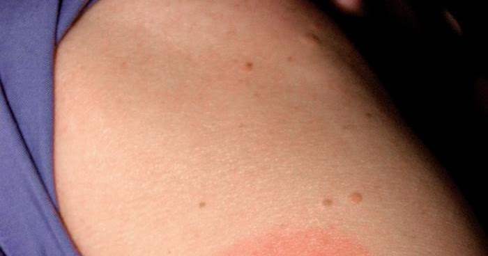 José Antonio Gelpi Méndez: Eritema migratorio en el diagnóstico de la Enfermedad de Lyme