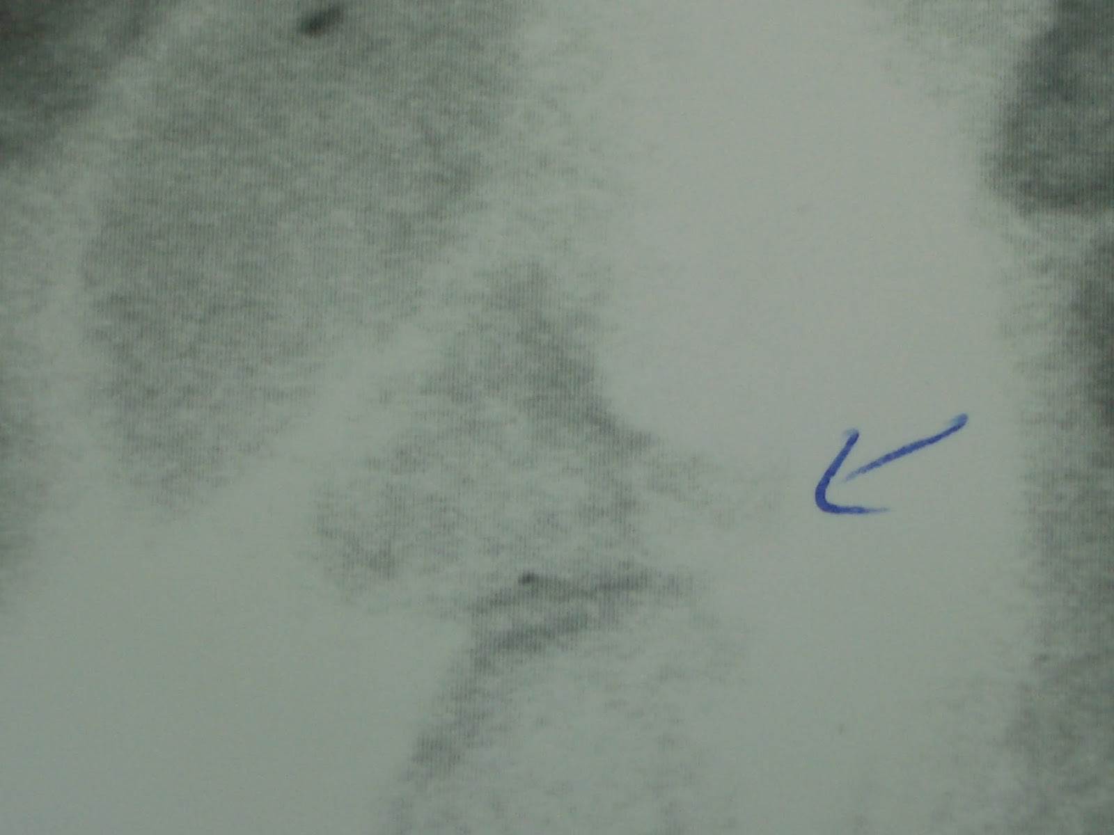 Podo Basas al Día: Operación de heloma interdigital. Operación de ojo ...