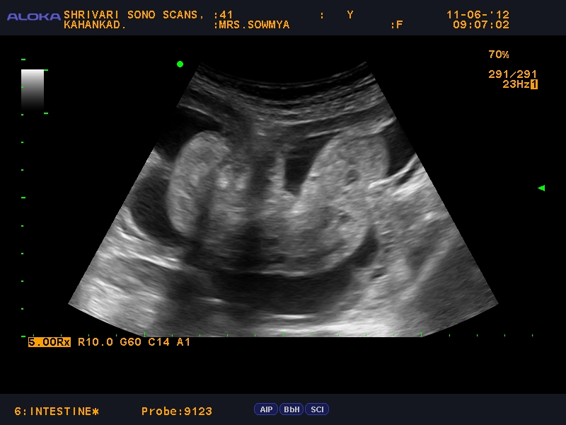 Shrivari Sono Scans: Small bowel intussusception secondary to ...