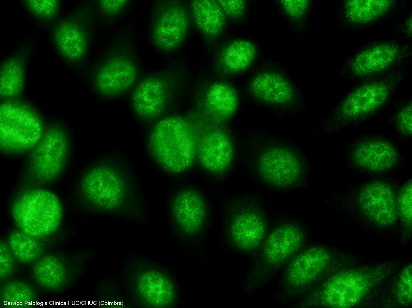 Anticorpos anti - SSA (Ro) e anti - SSB (La)