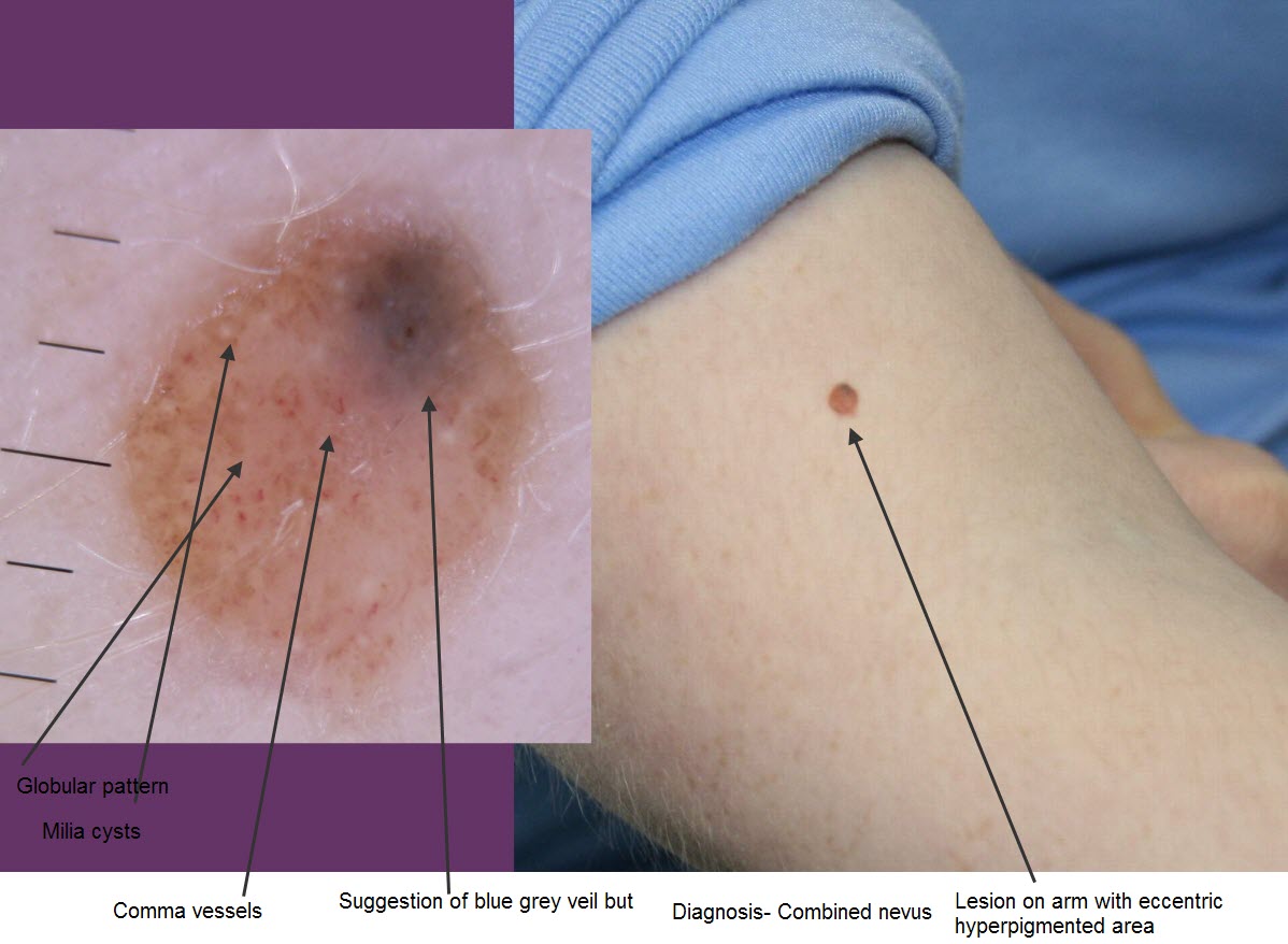 Combined Nevus