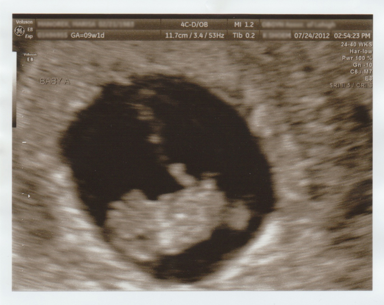 Wishing for Our Little Star: 9 Weeks 1 Day