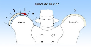 Ângulo de Cobb e Índice de Risser :: Referências Radiológicas