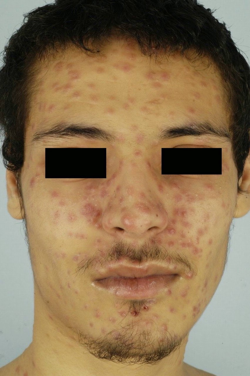 SKIN DISEASE TYPES: Secondary Syphilis