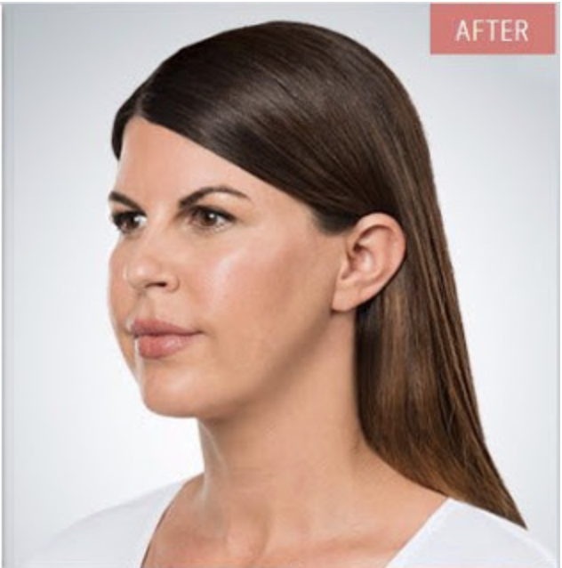 Chin Contouring 101 - The Skin Radar