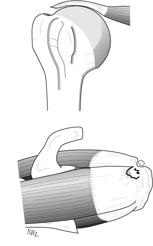 UW Shoulder and Elbow Academy: Rotator Cuff 4 - Mechanisms of Tear ...