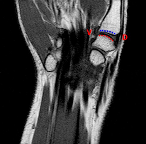 MRI Musculo-Skeletal Section: Thumb carpo- metacarpal joint.