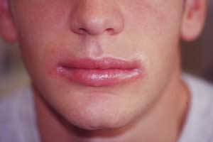 French Vocabulary Illustrated: dartre