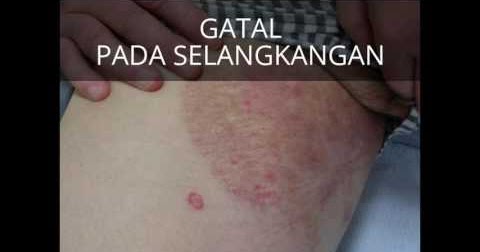 Apotik Herbal Alami: gatal kurap selangkangan dan buah zakar parah