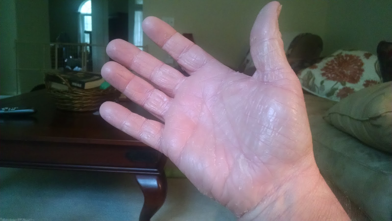 The Pityriasis Chronicles: Back to the Timeline