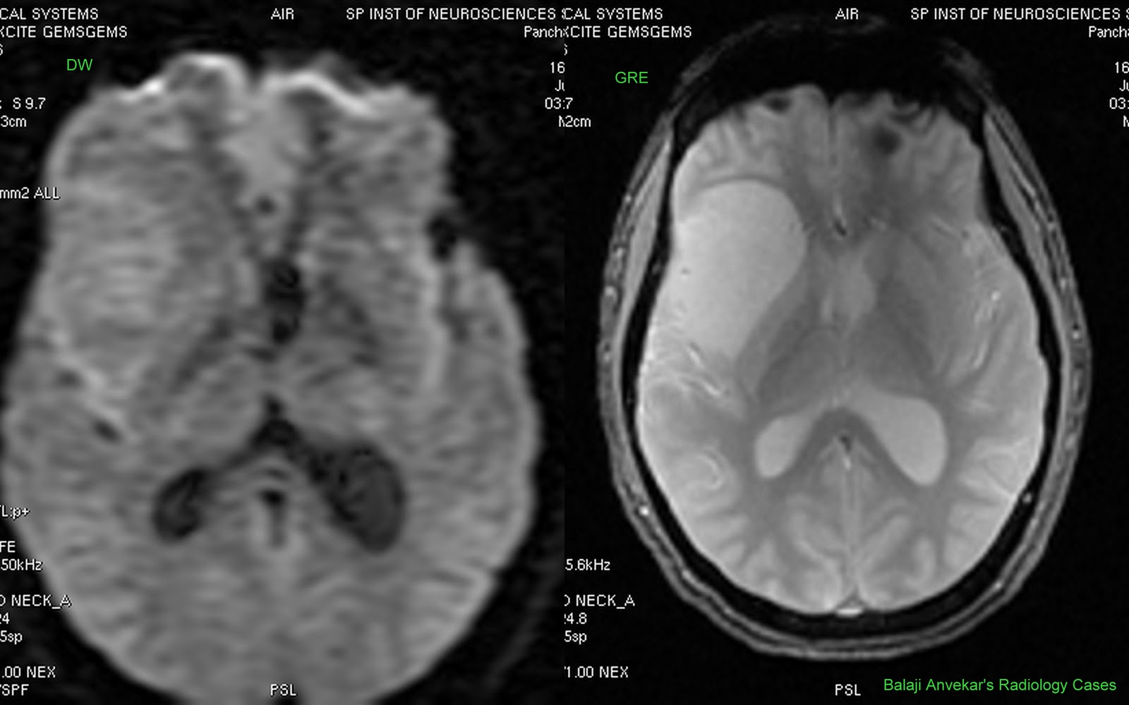 Dr Balaji Anvekar FRCR: Anaplastic Astrocytoma MRI