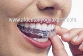 Retainer transparan / invisible di Yogyakarta ~ AF Dental Laboratory ...