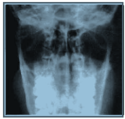 Cara (orbitas, huesos propios de la nariz (HPN), senos paranasales (SPN ...