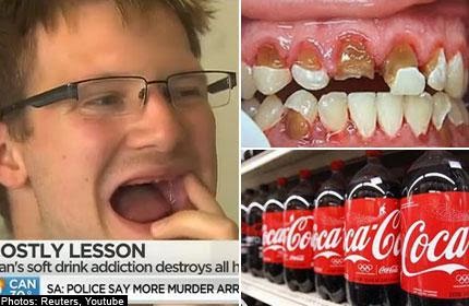 Ortodontia é Arte: Coca Cola x Dentes X Aparelho Ortodôntico Fixo