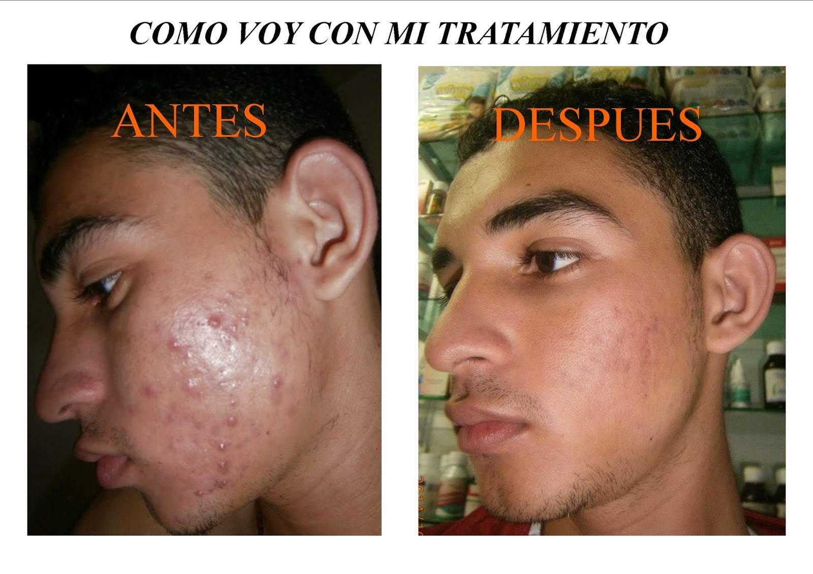 Acne Vulgar Tratado Con ISOTRETINOINA