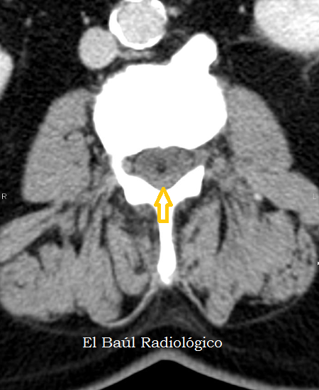 El Baúl Radiológico: LIPOMAS DEL "FILUM TERMINALE": HALLAZGOS EN TC y ...