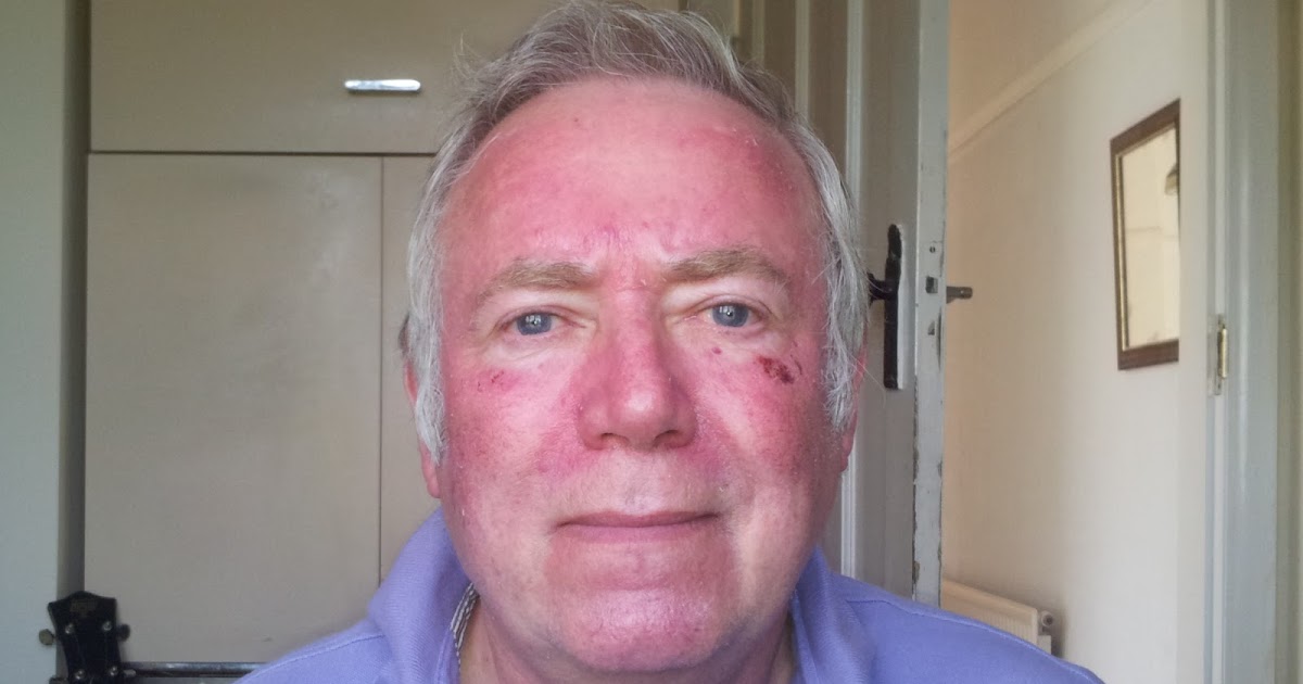 Alan's Efudix/Efudex Experience