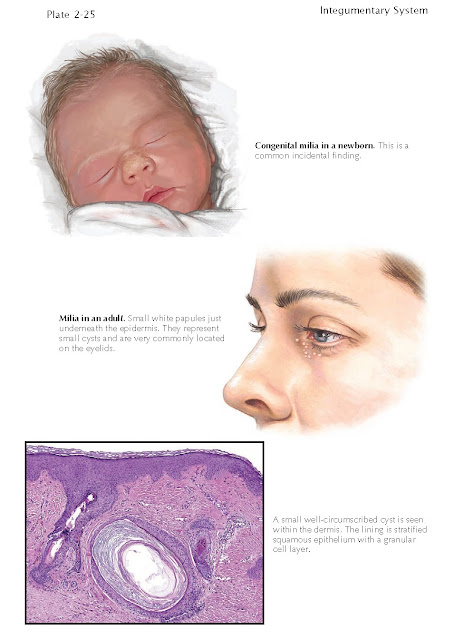 Milia - pediagenosis