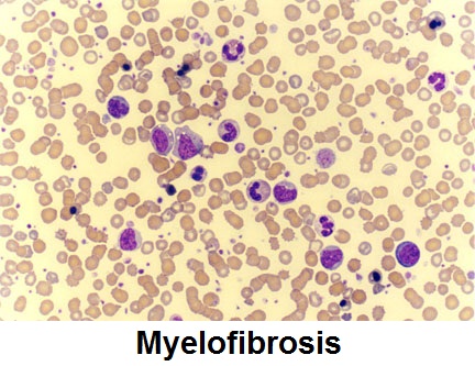 Myelofibrosis Symptoms And Treatment - What Is Myelofibrosis? | Health ...
