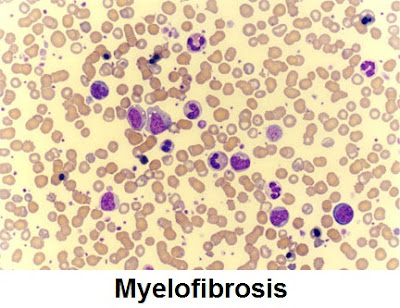 Myelofibrosis Symptoms And Treatment - What Is Myelofibrosis?