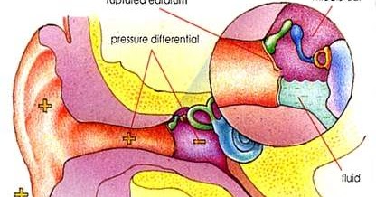 Barotrauma ear mri - velogilit