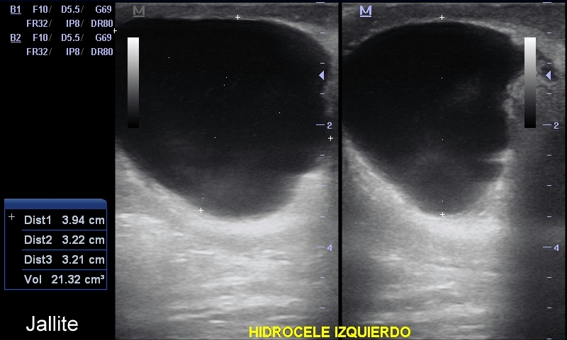 Tuberculosis Testicular