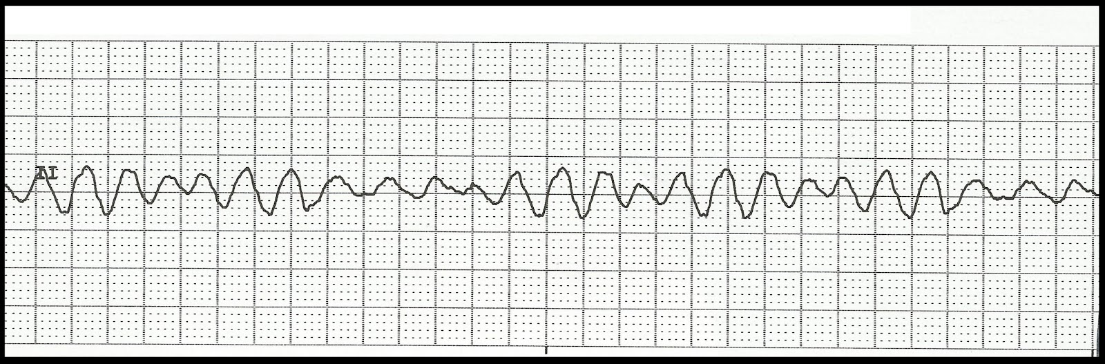 ECG Rhythm Strip Quiz 97: Ventricular Rhythms
